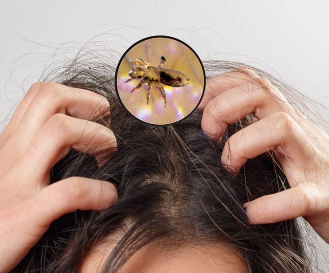 Home Remedies For Lice सिर में हो गई है जूं और लीख तो इन्हें जड़ से